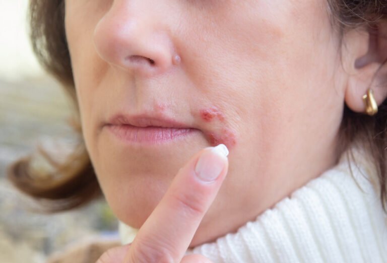 Herpes - ThriveTeleMed